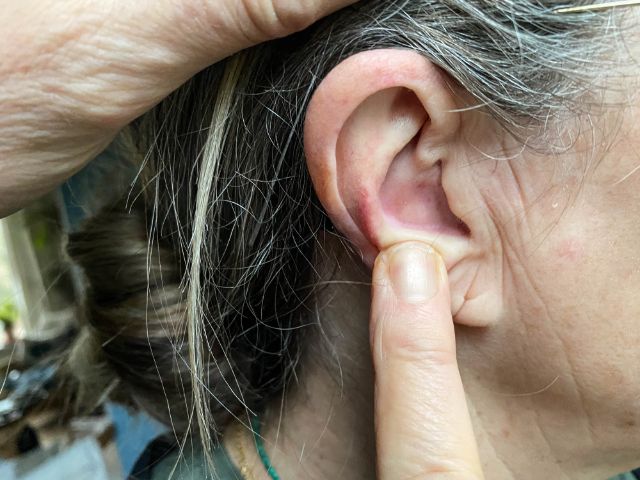 Ear Eczema: types and difference with dermatitis and psoriasis