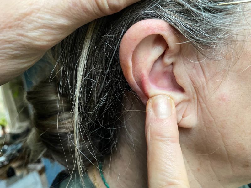Ear Eczema: types and difference with dermatitis and psoriasis